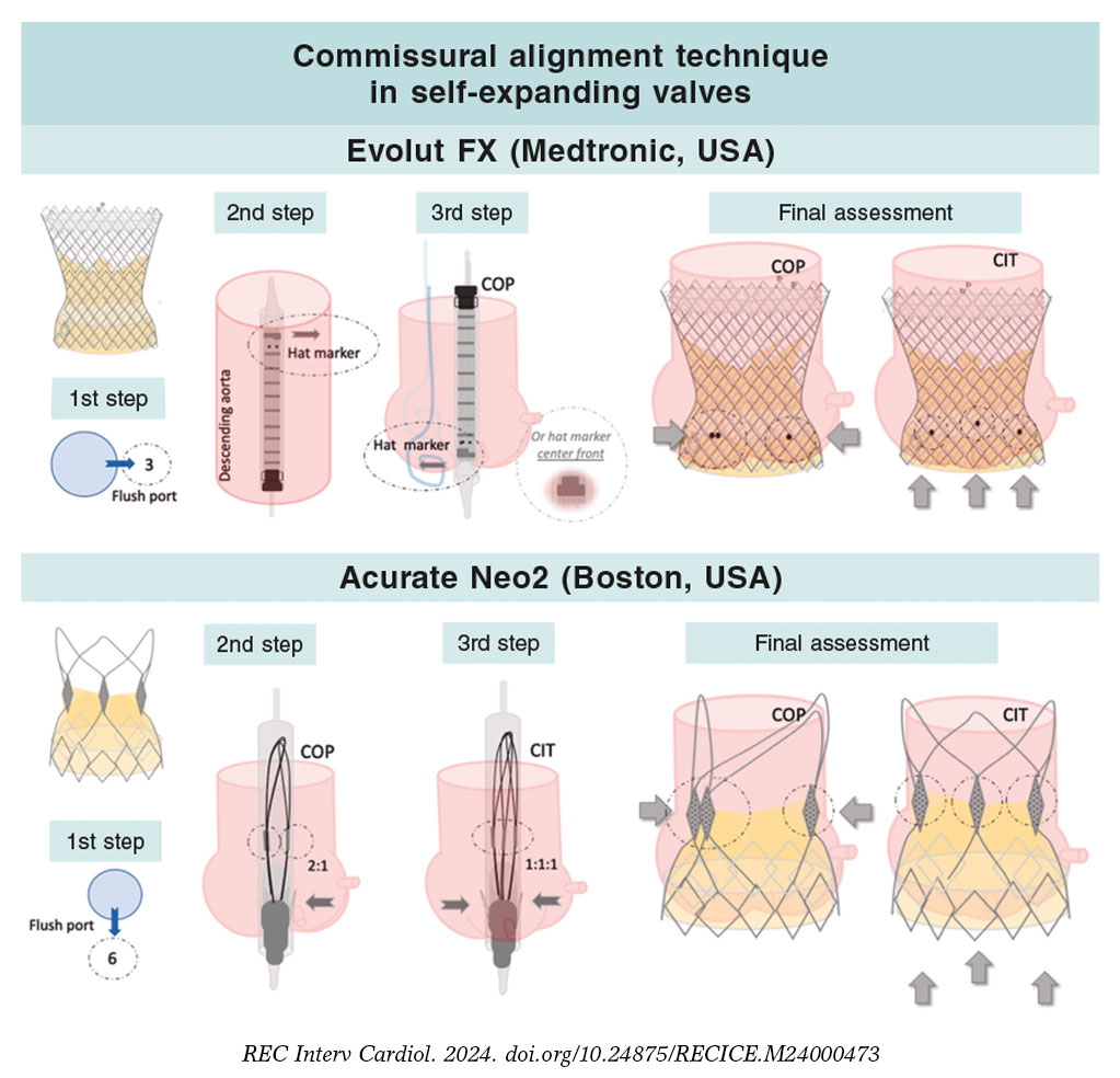 The role of implant projection in optimizing transcatheter aortic valve ...