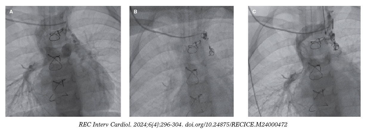 Management of collaterals after Glenn procedure and its impact on ...