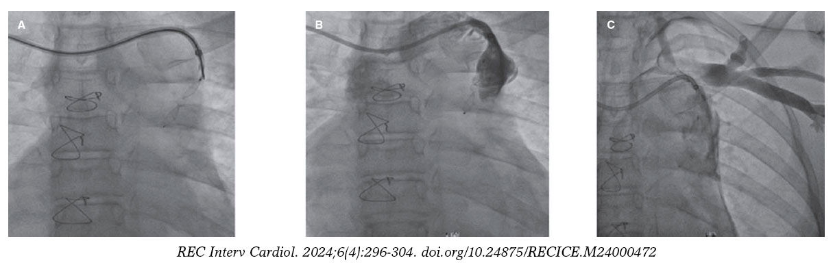 Management of collaterals after Glenn procedure and its impact on ...
