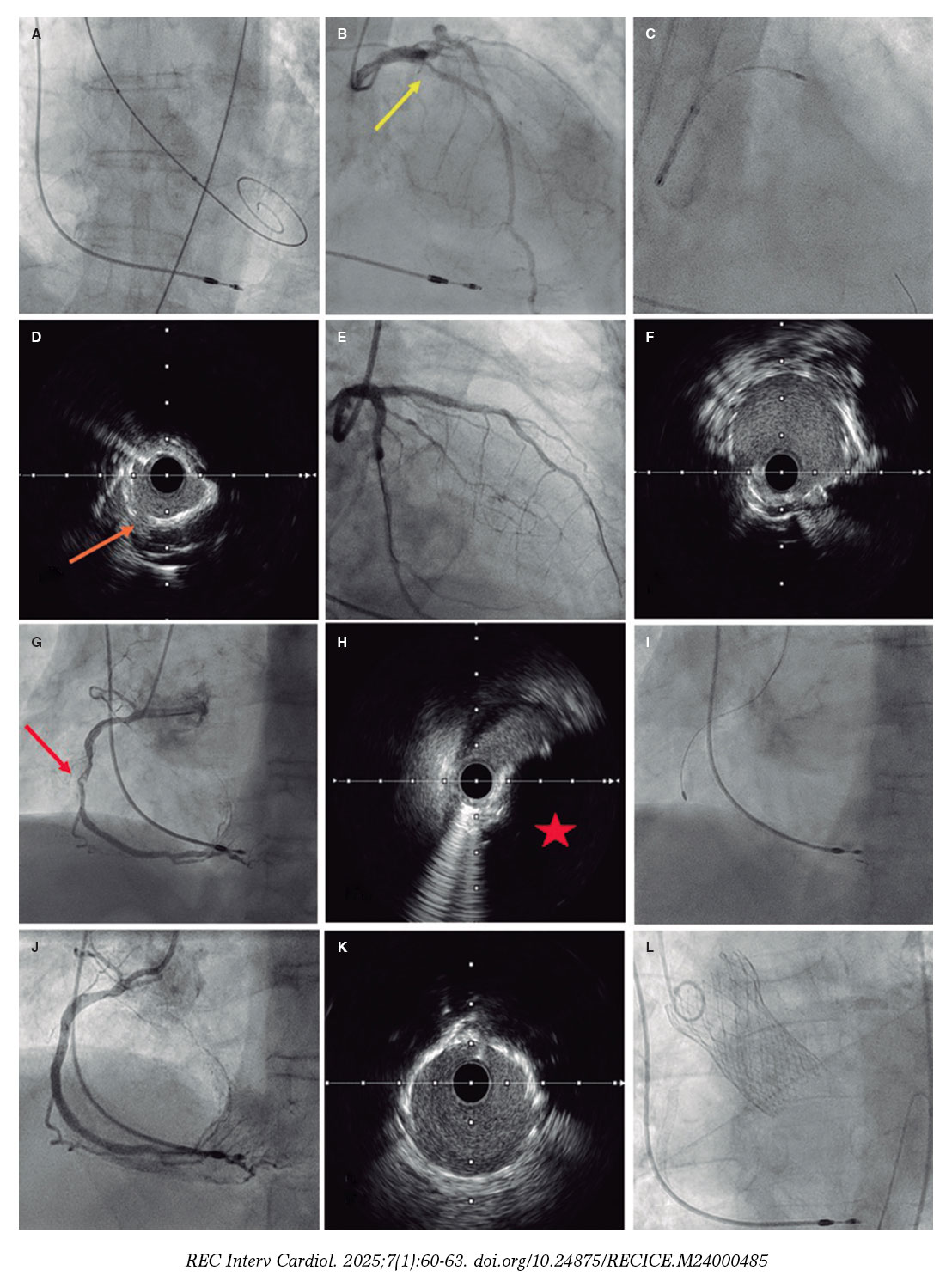 Plaque modification techniques in patients with CHD undergoing TAVI ...