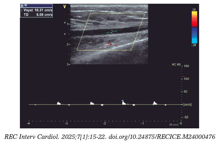 Incidence and predictors of radial artery occlusion following ...