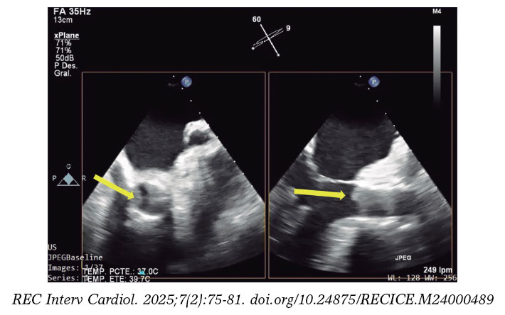 Infectious endocarditis on percutaneous aortic valve prosthesis ...