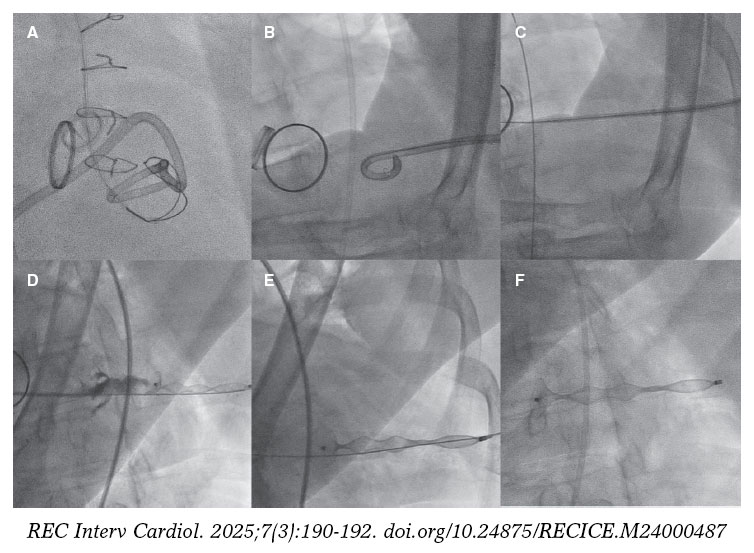 Percutaneous closure of left ventricular puncture after thoracentesis