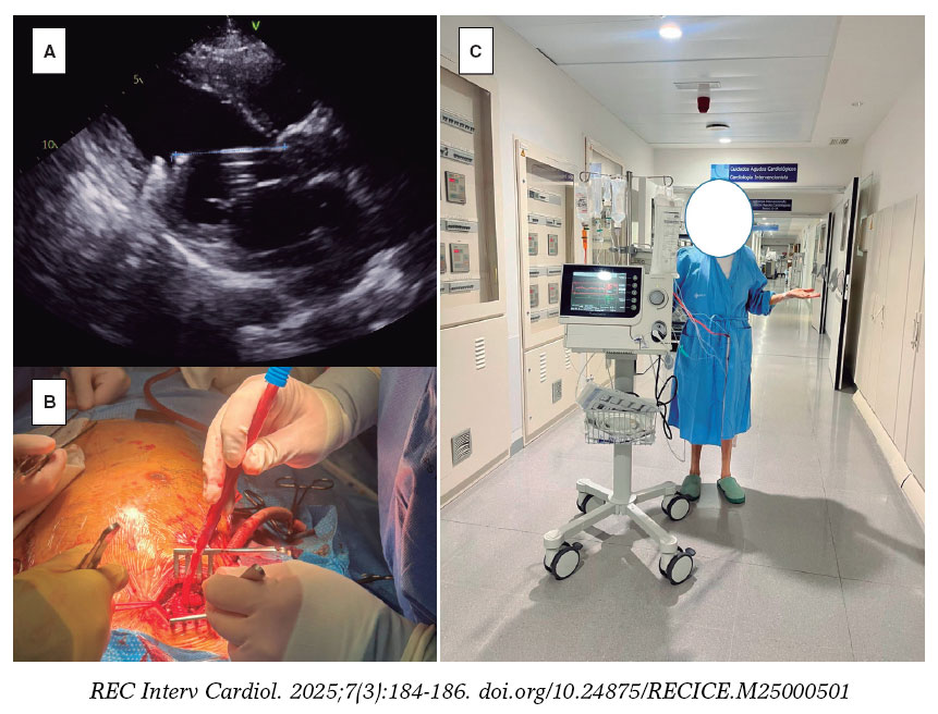 High capacity Impella, an effective mechanical support strategy for ...