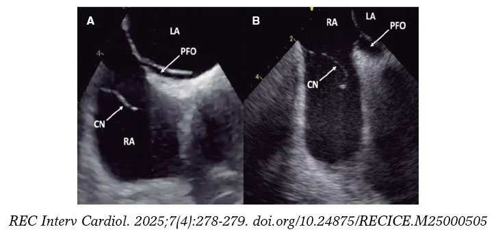 Chiari network. A potential enemy in patent foramen ovale closure