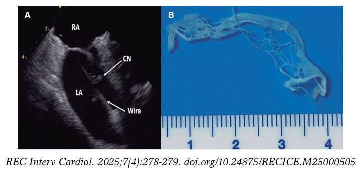 Chiari network. A potential enemy in patent foramen ovale closure