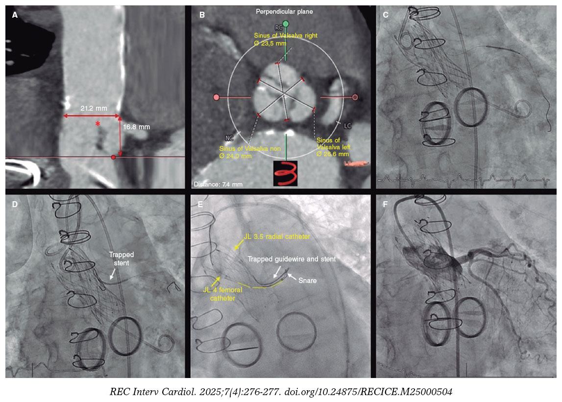 Coronary protection in TAVI: use of the guide catheter extension system