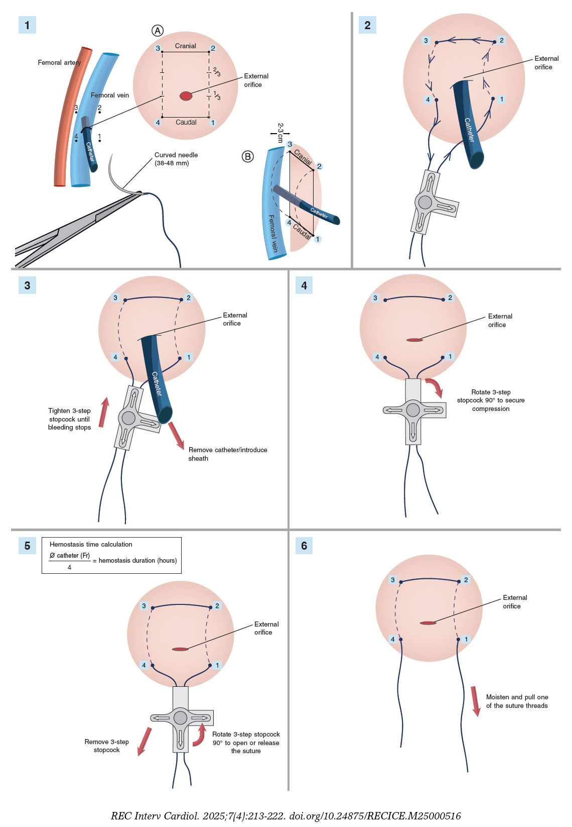 Purse-string suture and 3-way stopcock for effective venous hemostasis ...