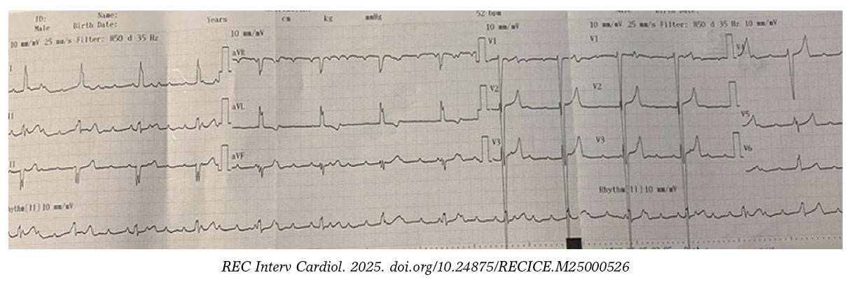 Heart block after transcatheter septal defect closure in infants under ...