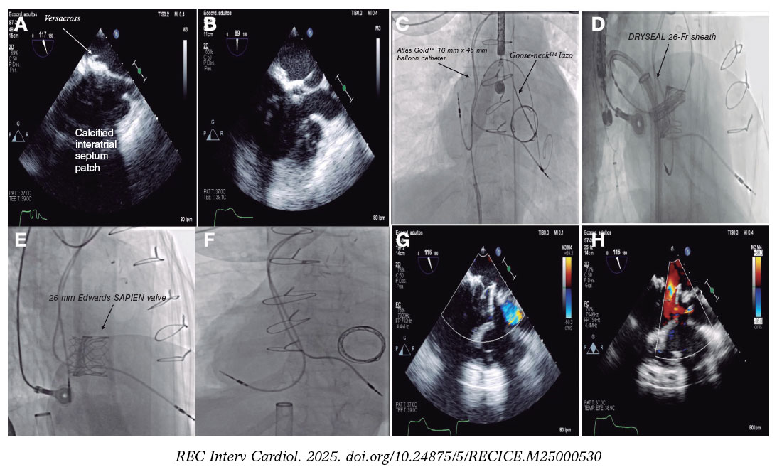 Mitral valve-in-valve with severe atrial septum calcification