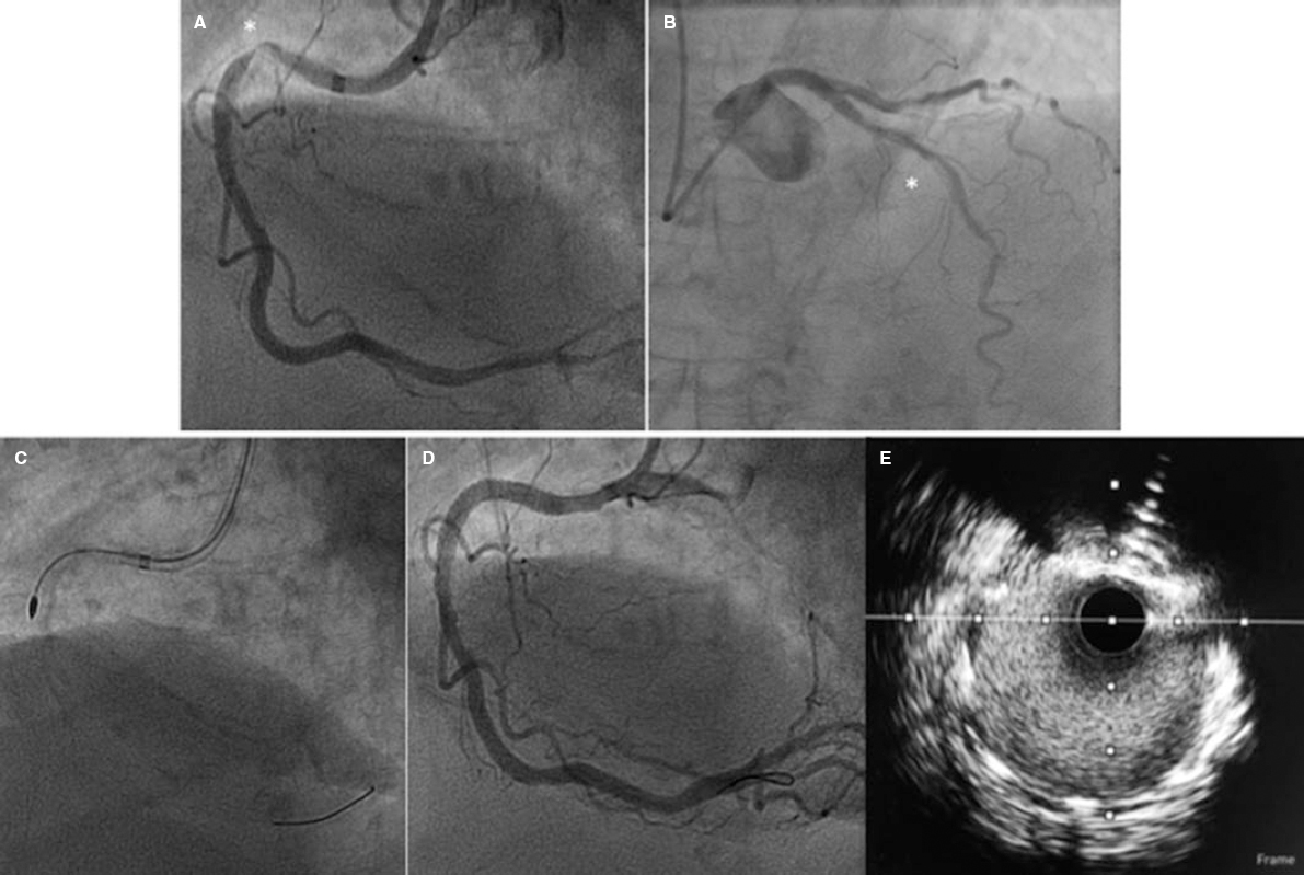 Left main coronary artery perforation after rotational atherectomy
