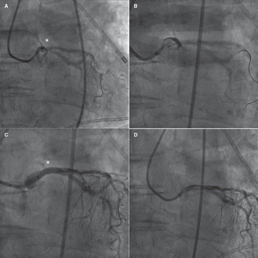 Left main coronary artery perforation after rotational atherectomy