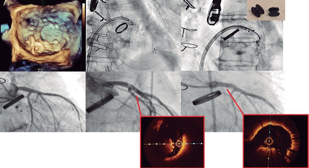 Left main coronary artery embolization after transcatheter paravalvular ...