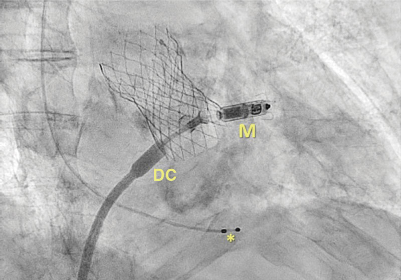 Micra leadless pacemaker and transcatheter aortic valve implantation at ...