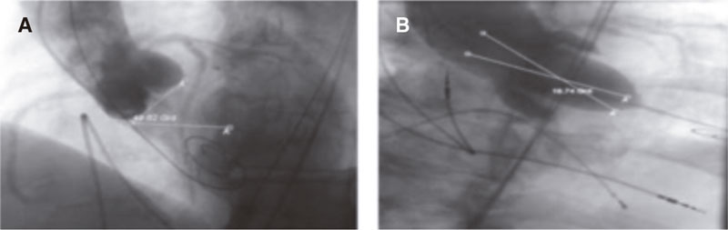 Transcatheter aortic valve implantation using Evolut PRO versus SAPIEN ...