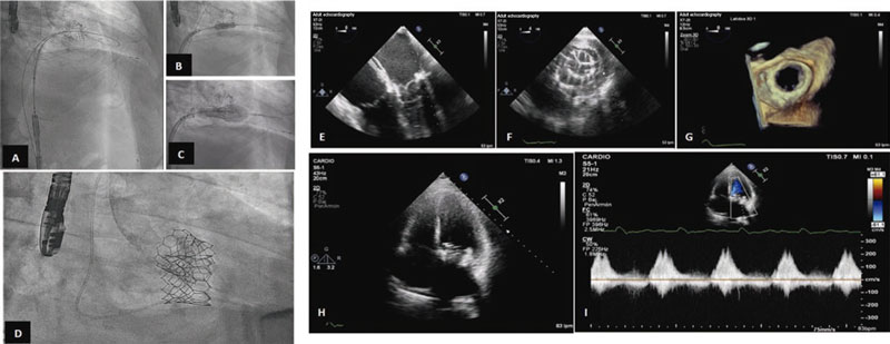 Transfemoral valve-in-MAC implantation due to severe radiation-induced ...