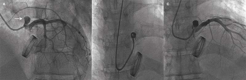 Percutaneous closure of coronary ostial anastomoses pseudoaneurysm ...