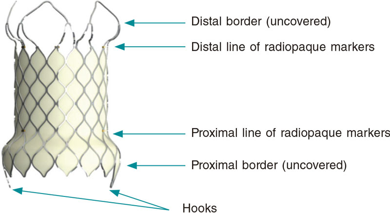 Initial experience with the new percutaneous pulmonary self-expandable ...