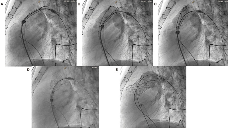 Initial experience with the new percutaneous pulmonary self-expandable ...