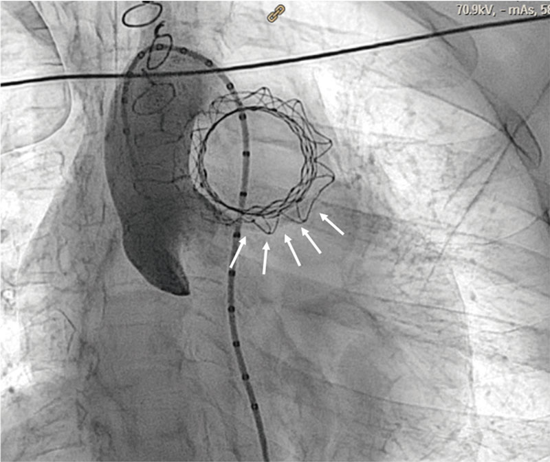 Initial experience with the new percutaneous pulmonary self-expandable ...