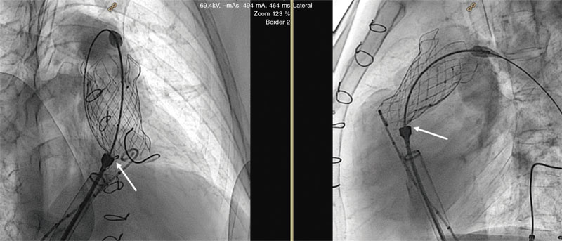Initial experience with the new percutaneous pulmonary self-expandable ...