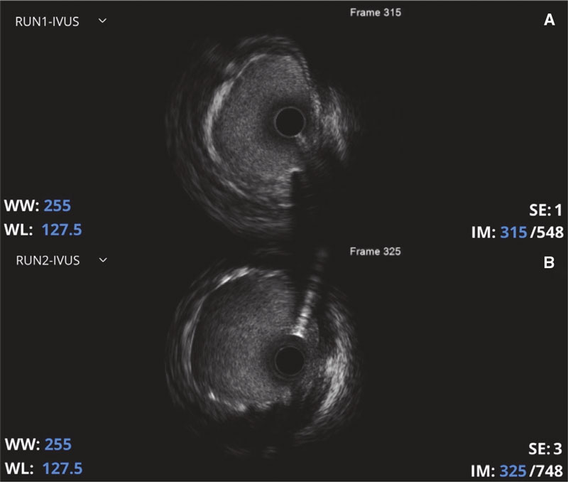 Syphilitic aortitis as a rare cause of coronary ostial stenosis