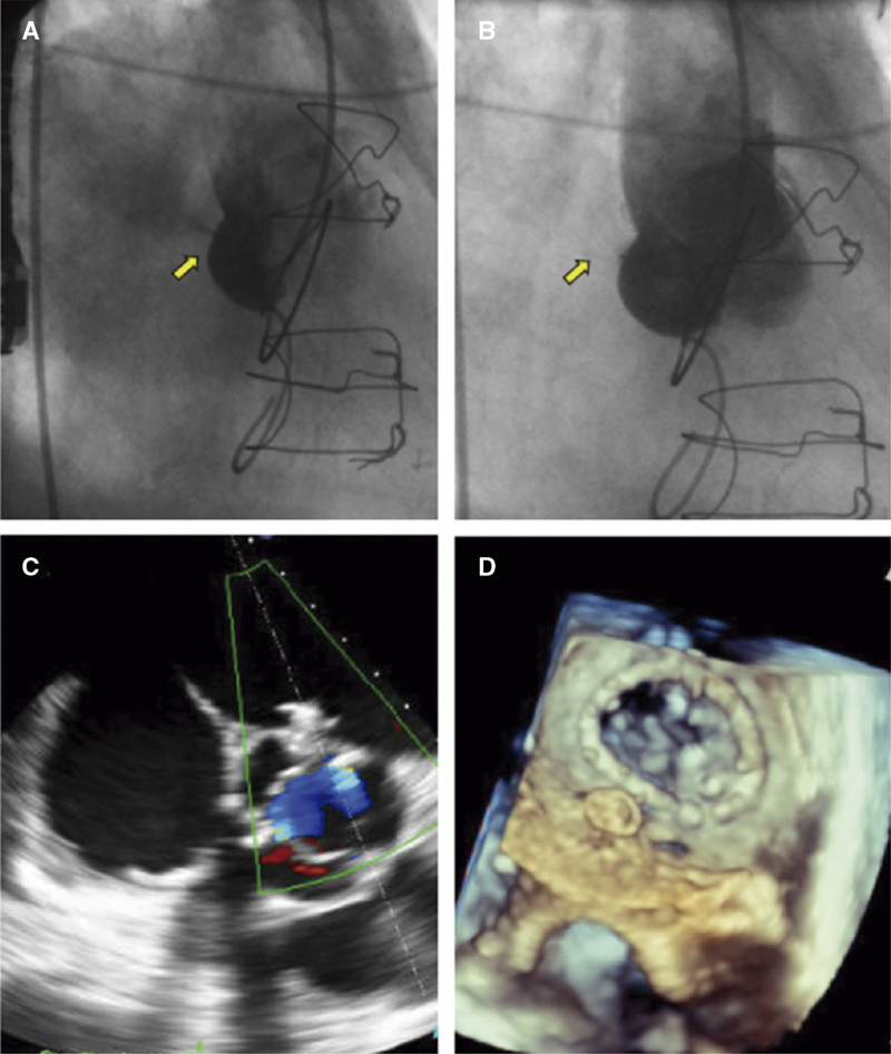 Right atrium: a good ally in left ventricular pacing during ...