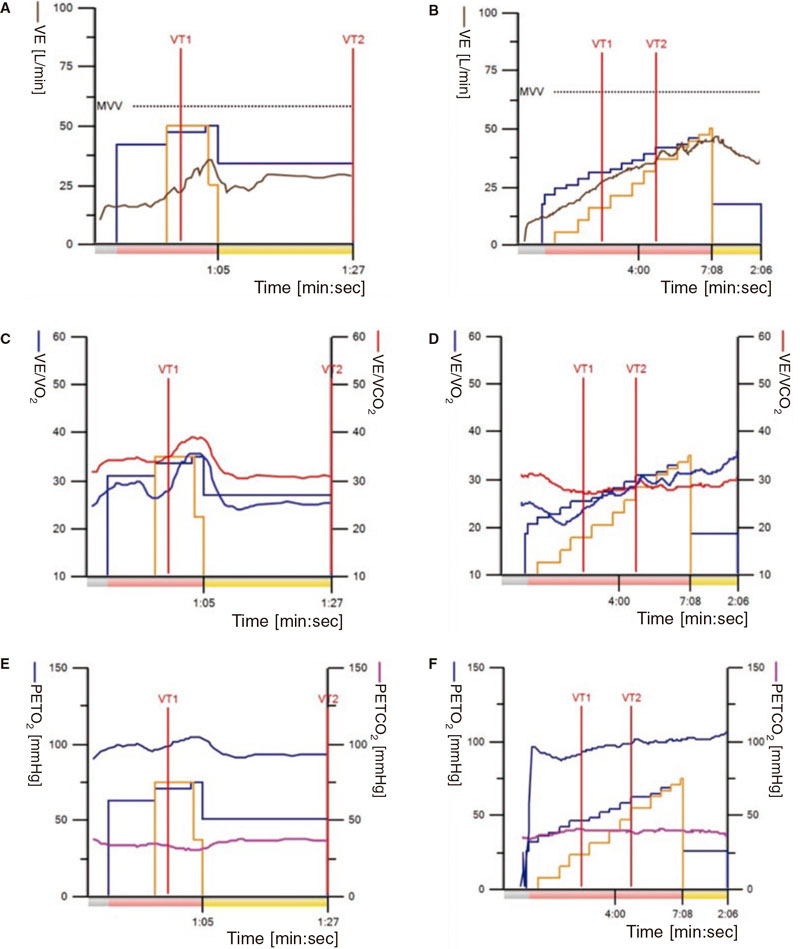 Provoked exercise desaturation in patients with patent foramen ovale ...