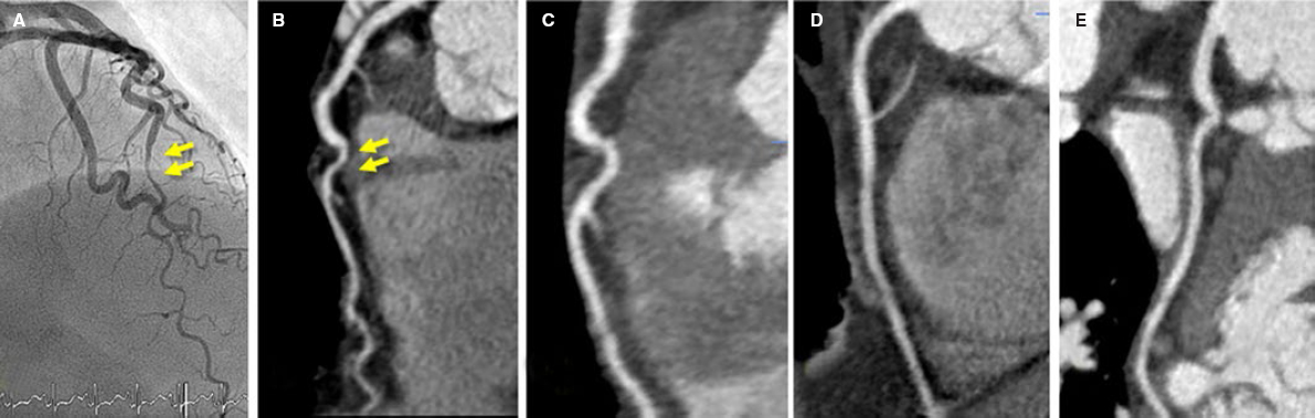 Contemporary management of spontaneous coronary dissection