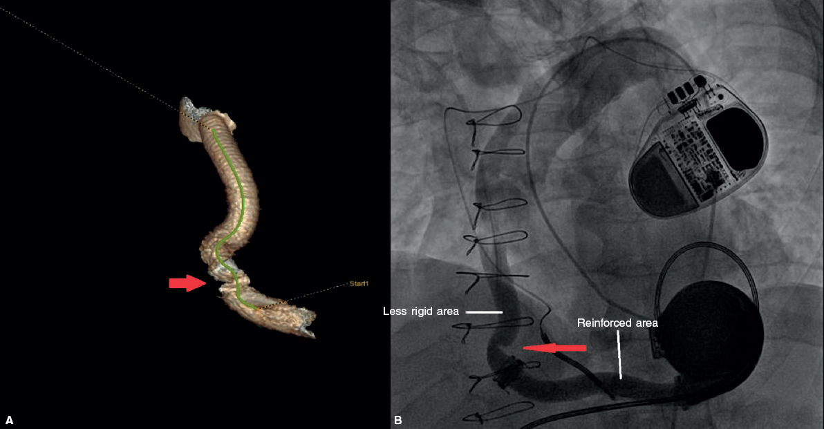 Stent implantation in a left ventricular assist device