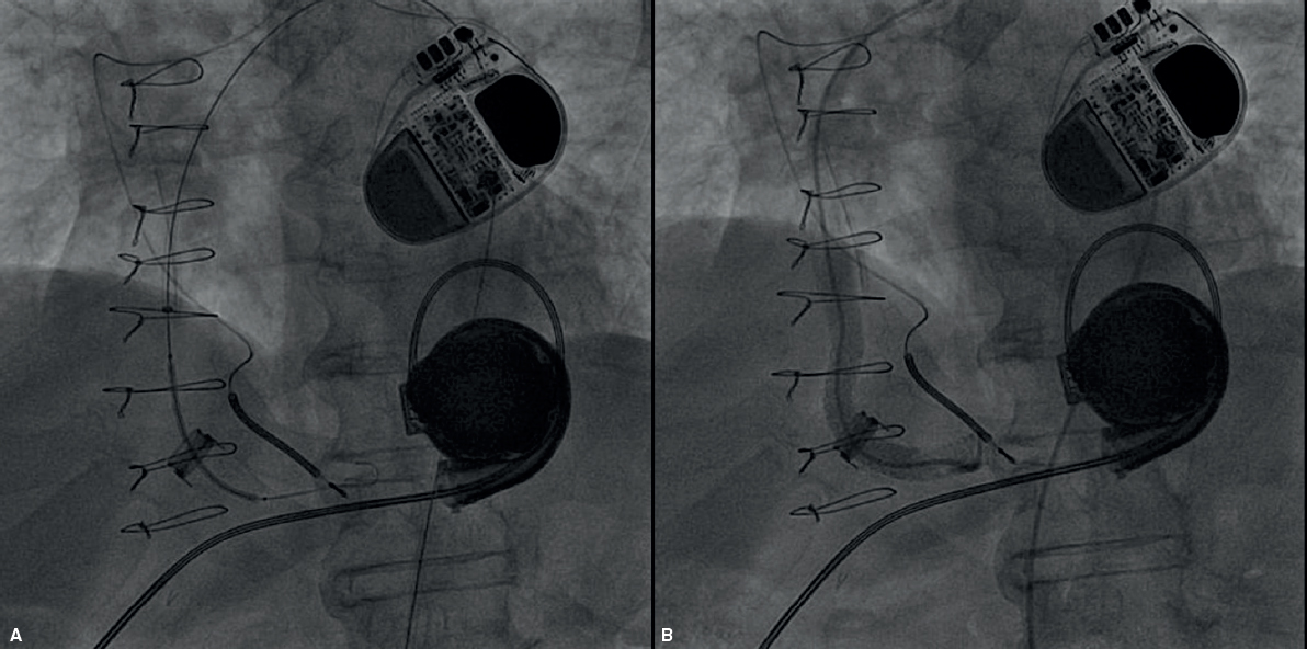 Stent implantation in a left ventricular assist device