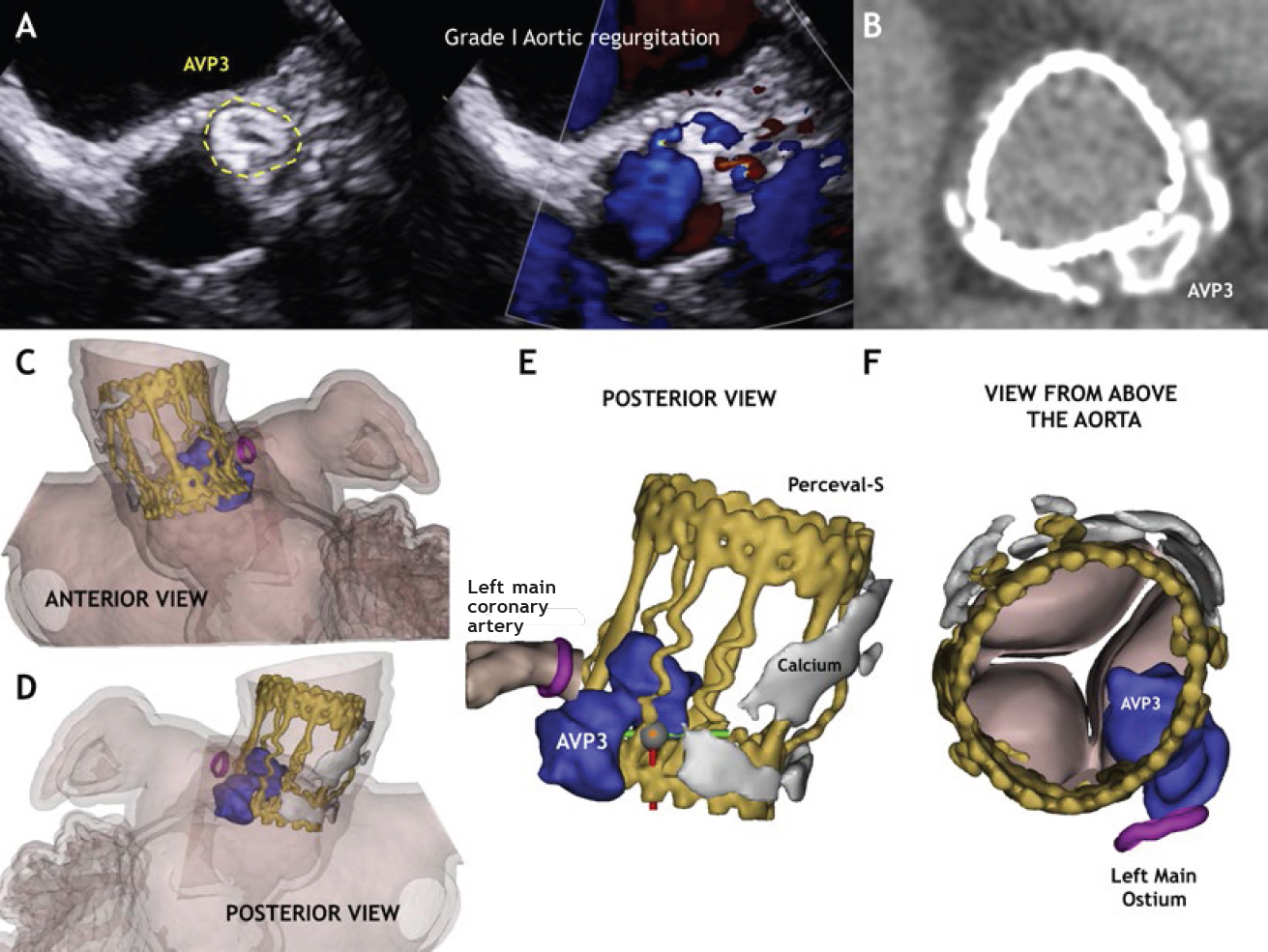 Paravalvular leak closure in a Perceval-after-Mitroflow procedure ...