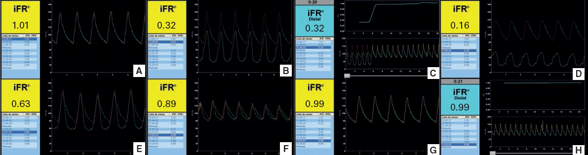 iFR variations during coronary angioplasty