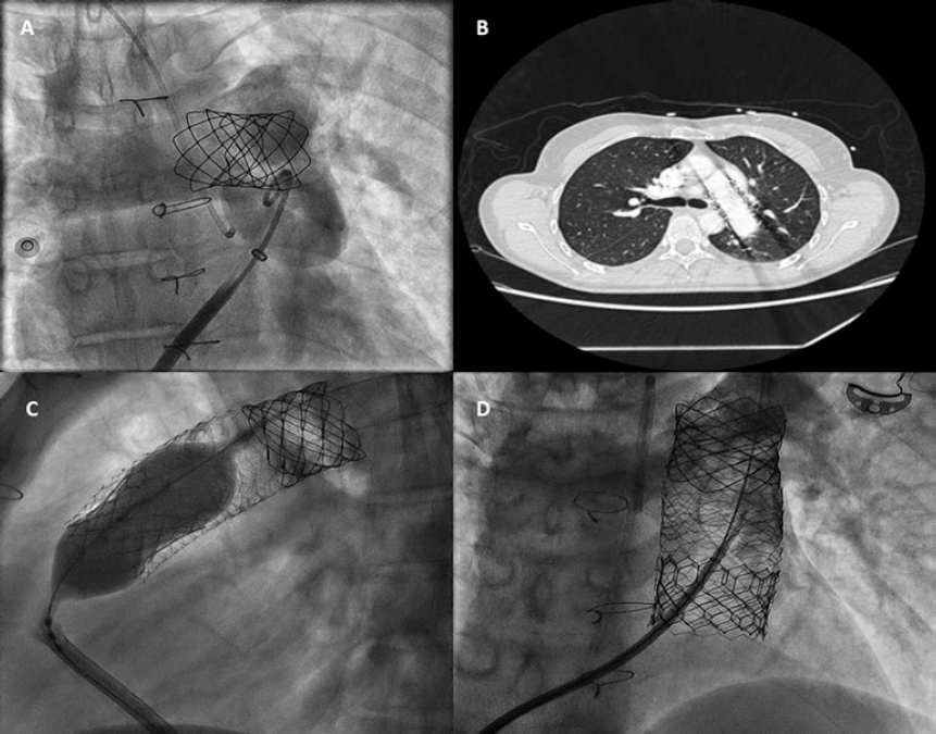 Percutaneous reconstruction of pulmonary trunk to solve stent embolization