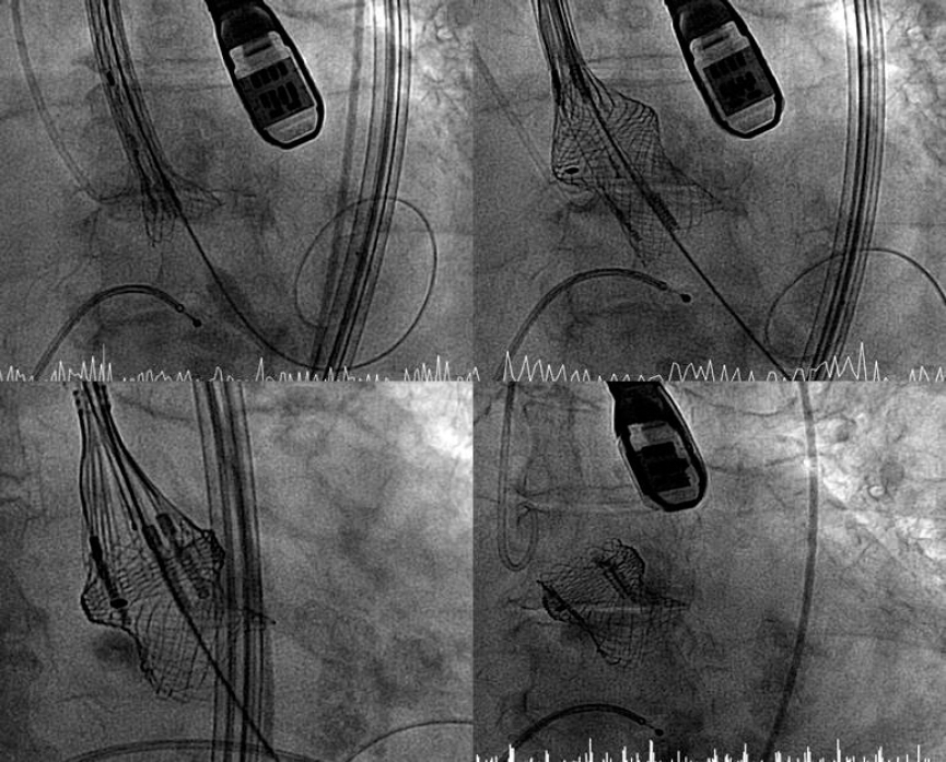 Multicenter experience with a second-generation fully-retrievable and ...