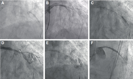 Coronary perforation after intracoronary lithotripsy in a chronic total ...