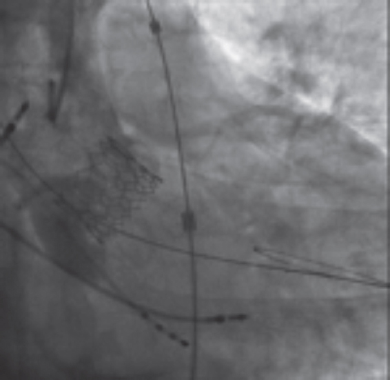 Specific indications for TAVI