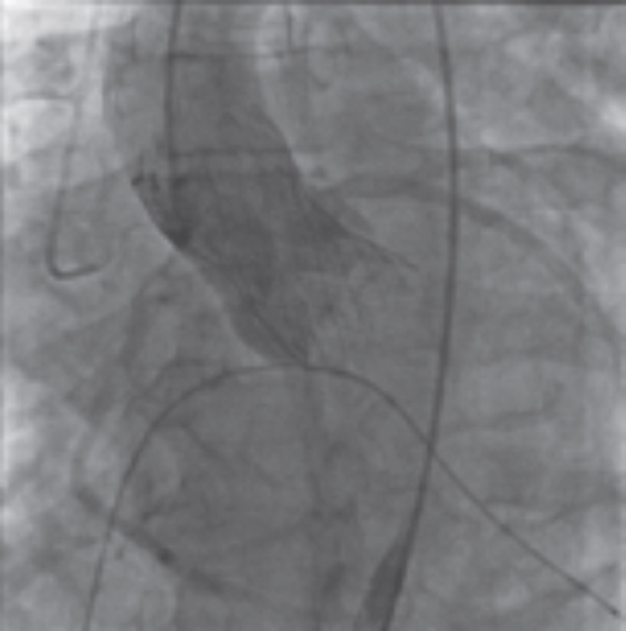 Specific indications for TAVI