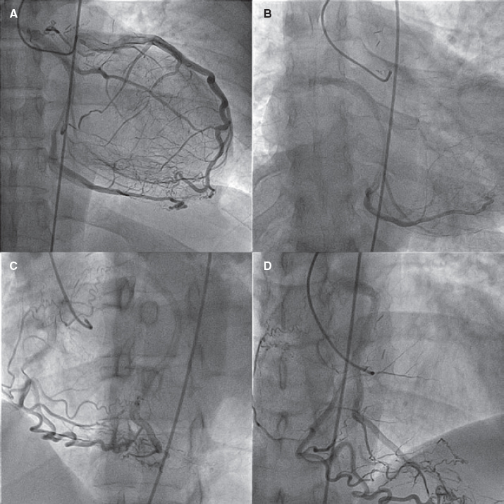 Anomalous origin of left circumflex artery from the right pulmonary ...