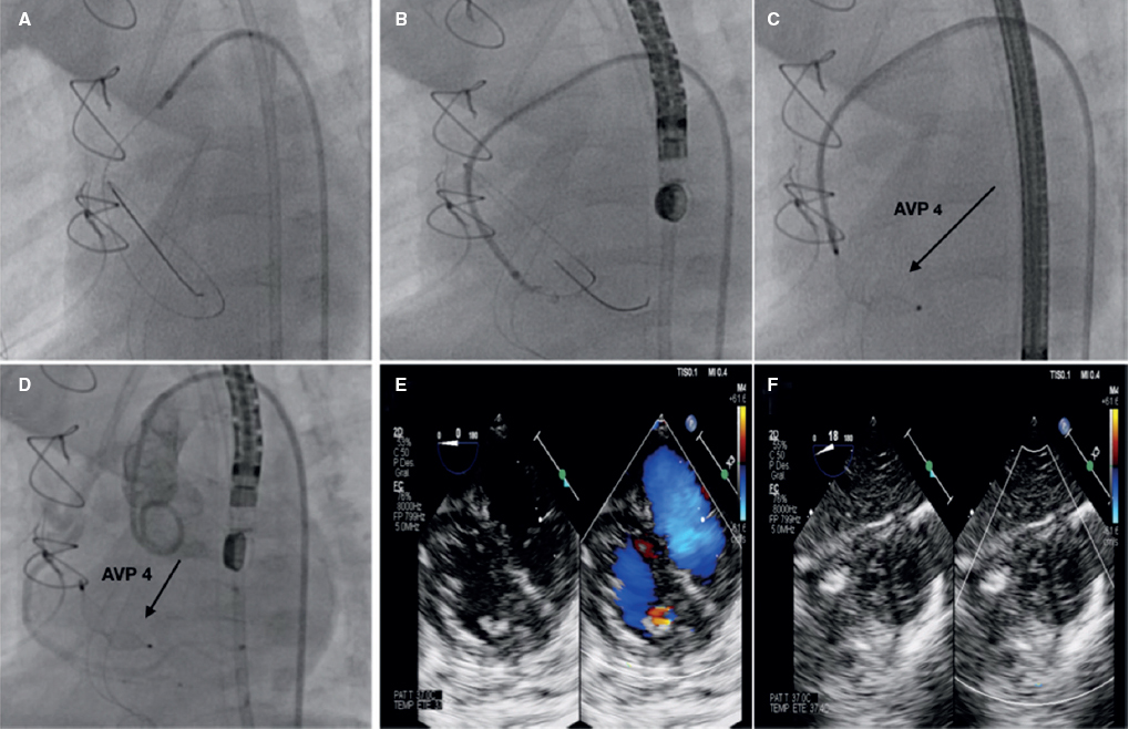 Percutaneous closure of coronary fistulae using different devices