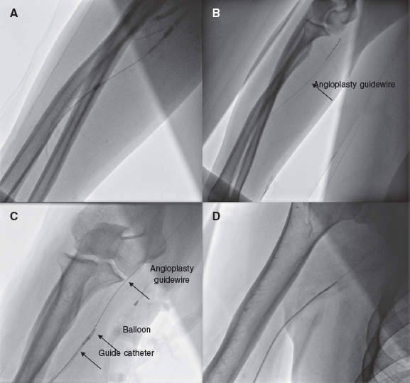 Utility of balloon-assisted tracking in radial arterial access