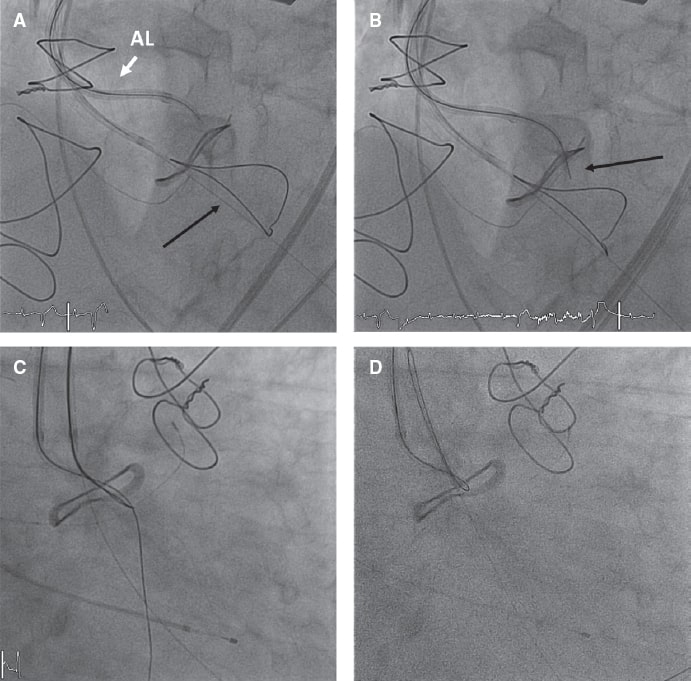 Prevention of coronary occlusions during transcatheter aortic valve-in ...