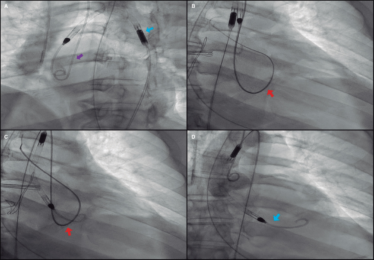 New technique for the emergent repositioning of the displaced Impella ...
