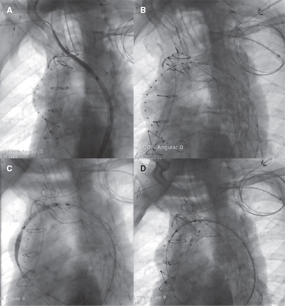 Endovascular repair of the aortic arch with the NEXUS Stent Graft System