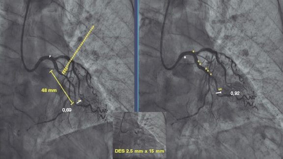 Usefulness of physiological coronary assessment with iFR in daily ...
