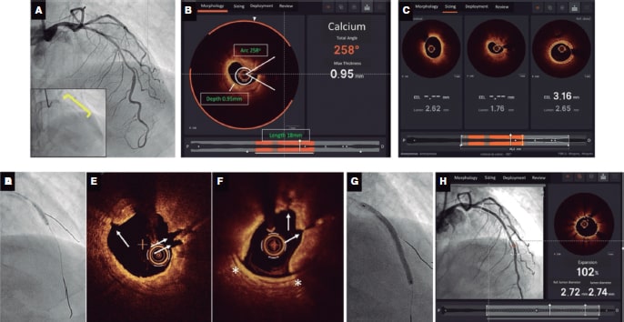 Calcified coronary artery disease: pathophysiology, intracoronary ...