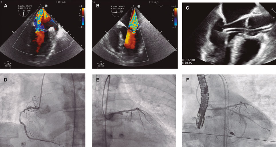 Impella-supported MitraClip implantation in acute mitral regurgitation