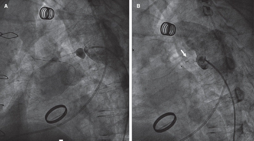 Ductus arteriosus presenting as systemic and pulmonary embolism