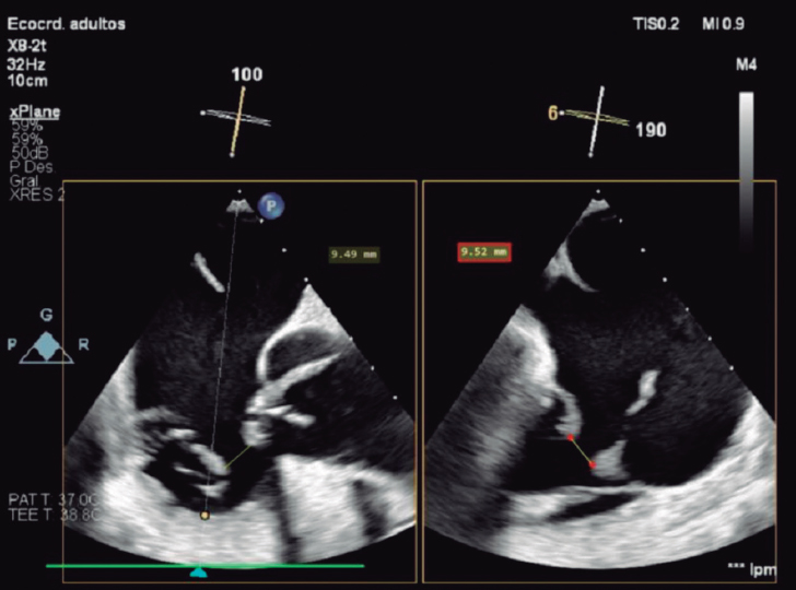Two simultaneous TriClip systems as a bailout technique