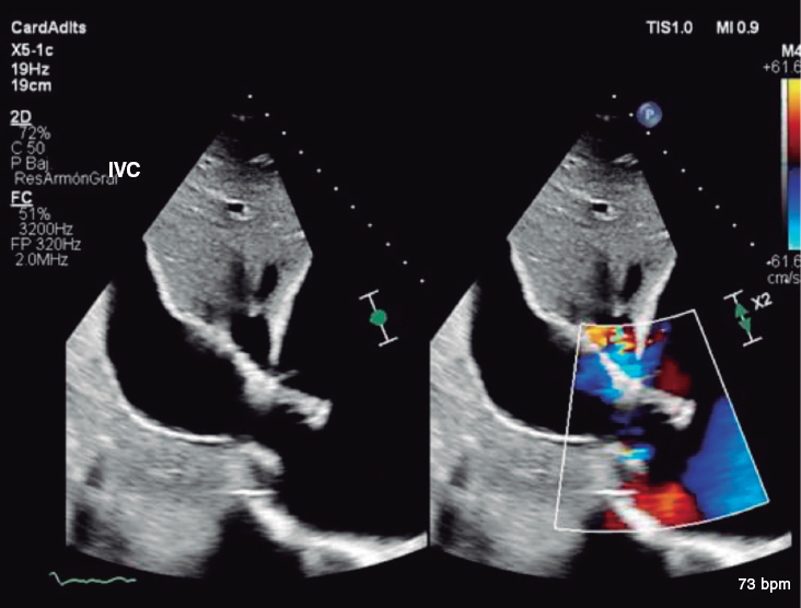 A new echocardiographic view for the TricValve system